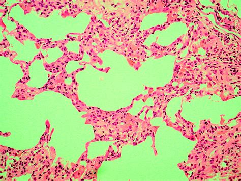 Respiratory Bronchiolitis Associated Interstitial Lung Disease Rb Ild