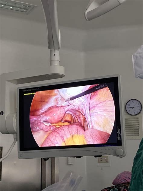 Ovarian Teratoma R Surgery