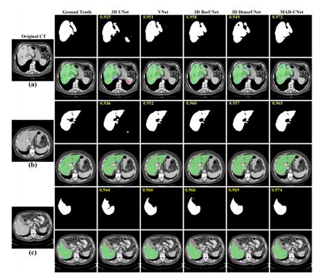 Multi Scale Attention And Deep Supervision Based D UNet For Automatic Liver Segmentation From CT