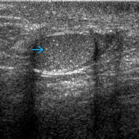 Undescended Testis Radiology Key