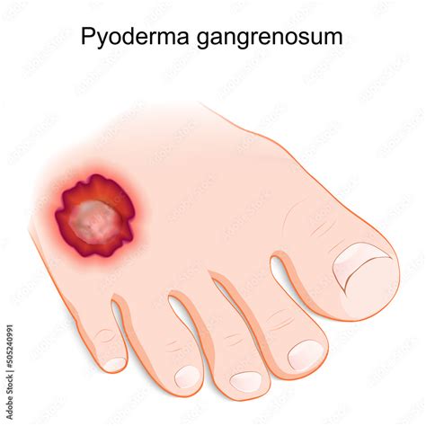 Pyoderma Gangrenosum Inflammatory Skin Disease Stock Vector Adobe Stock