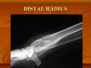 Osteosarcoma Ppt