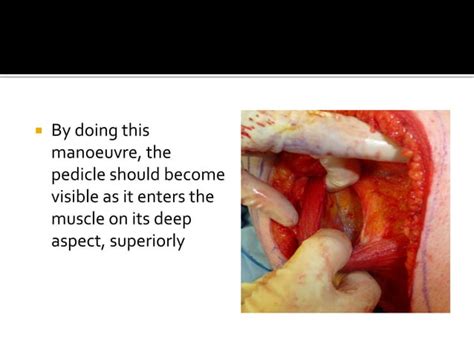 Free Ld Flap For Scalp Reconstruction Dr Vipin V Nair Pptx Death