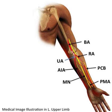 Pdf Bilateral Triad Of Persistent Median Artery A Bifid Median Nerve And High Origin Of Its