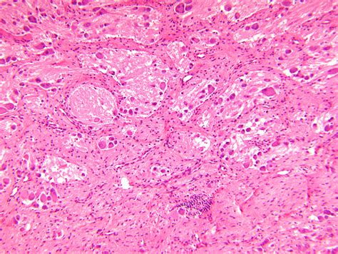 Pathology Outlines Ganglioneuroblastoma Intermixed Variant