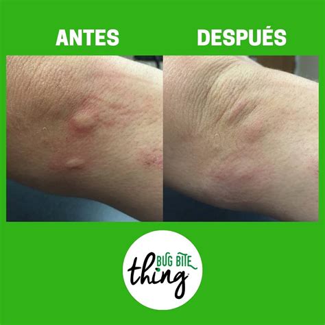 ¡alivio Natural Al Instante 🤩 Bug Bite Thing México Facebook