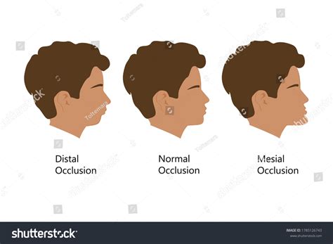 Guy Distal Normal Mesial Bite Profile Stock Vector Royalty Free