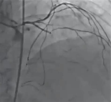 向定成教授言之有据，深入论证：缺血性心肌病ef≤35 ，首先选择血运重建 医谱