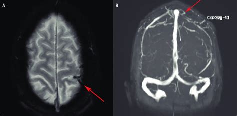 Gradient Recalled Echo Gre Sequences A With An Absence Signal Red