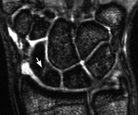 Scaphoid Fracture Mri