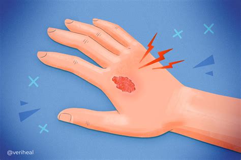 Skin Ulcer On Finger