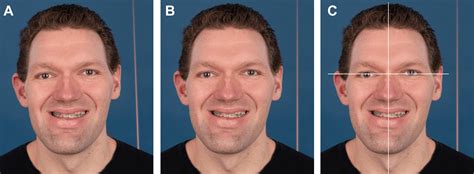 Management Of Asymmetry Oral And Maxillofacial Surgery Clinics