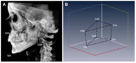 Measurements Of The Maxillomandibular Volume A Localization Of Ans