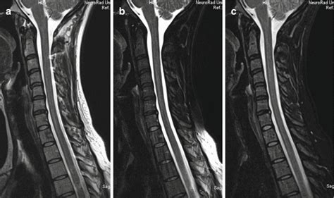 Magnetic Resonance Imaging Mri Methods Neupsy Key