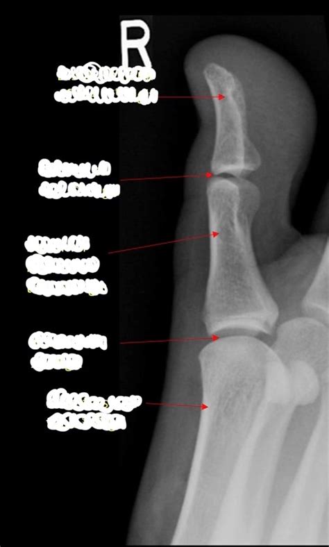 Lateral Toes Diagram Quizlet