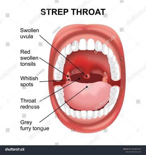 Streptococcal Tonsillitis Strep Throat Bacterial Infection Stock