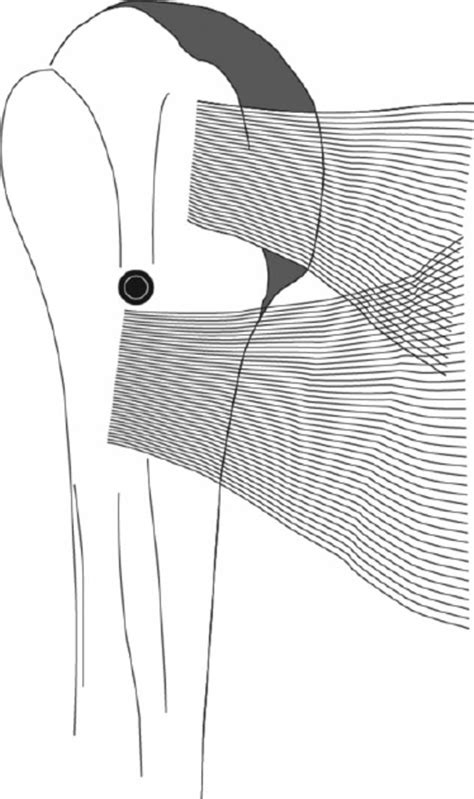 The Long Head Of The Biceps Is Placed Distal To The Bicipital Groove In