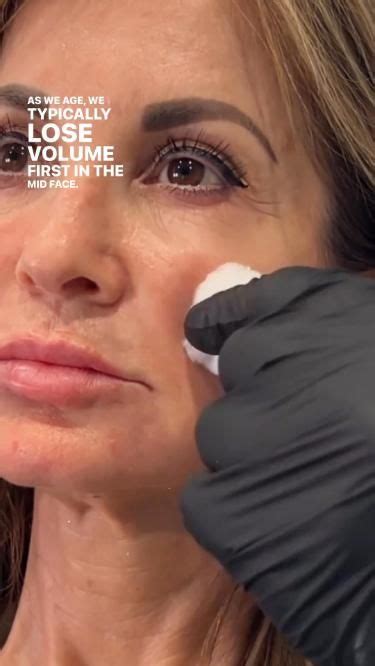 Cheek Filler Before After Anti Aging Skin Care Kits Facial Fillers Skin Care Routine