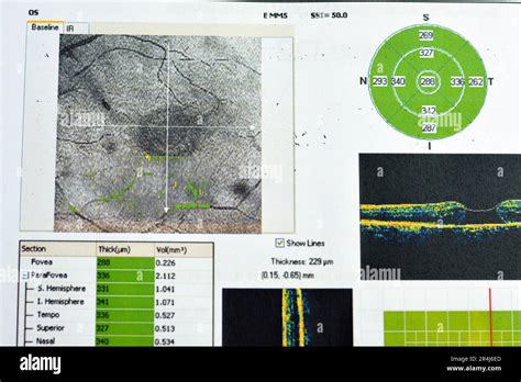 Oct Of The Eye Reveals Faint Epimacular Membrane And Full Thickness