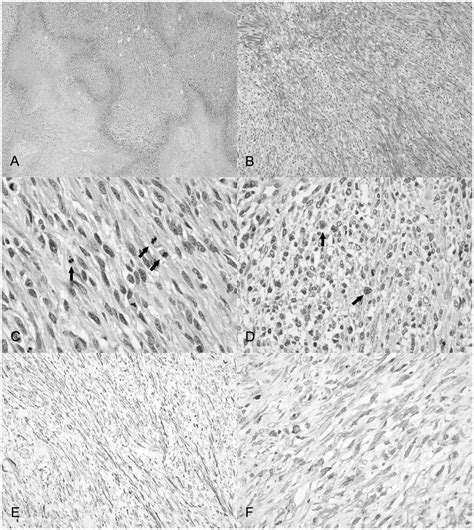 A The Tumor Shows A Fascicular Proliferative Pattern Of Download Scientific Diagram