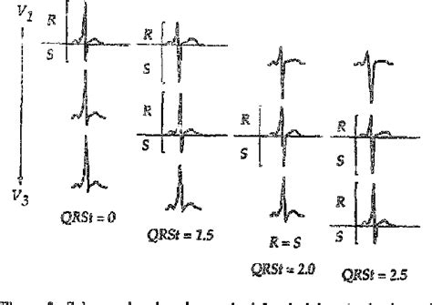 Figure 2 From New Algorithm For The Localization Of Accessory Atrioventricular Connections Using