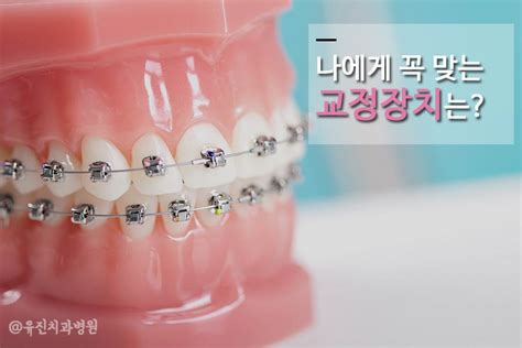 우리들40플란트치과병원 치아교정장치의 발달로 종류가 여러가지 있는데 어떤 장치를 선택해야