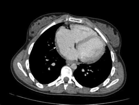 Axials Section Through The Thoracic Stage In The Mediastinal Window