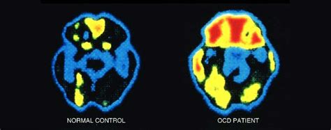 Ocd Brain Ocd When The Brain Misfires Danger Cues Cherry Hill