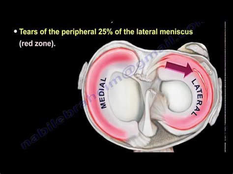 Lateral Meniscus Tear Posterior Horn