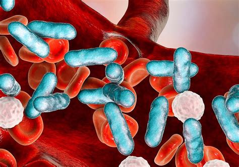 Sepsis Bigger Killer Than Cancer Worldwide According To Study Star Mag