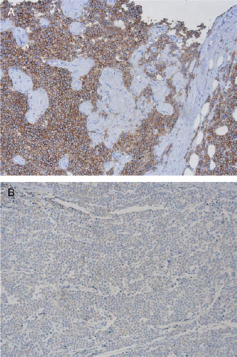Tumor That Displayed 3 Human Epidermal Growth Factor 2 Her2 Staining
