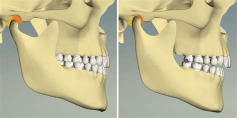 Orthodontic Ce Article Cone Beam Computed Tomography Guides Orthodontists To Detect Condylar