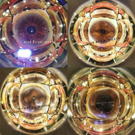 Smartphone Gonio Imaging The Truly Frugal Indian Revolution