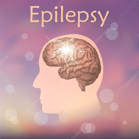 Epilepsy Illustration Stock Image F0221767 Science Photo Library