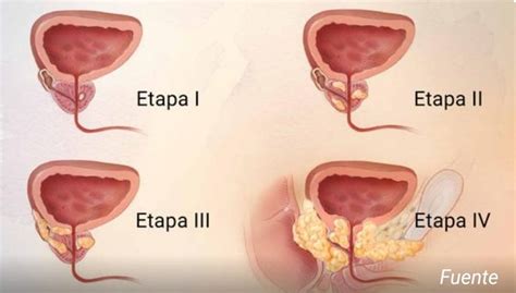 ¿qué Es El Cáncer Fase Iv Que Padece Pilo Tejeda