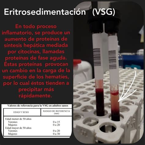 Eritrosedimentación Vsg Bioquímica Hematíes Agudas
