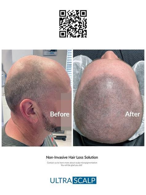 Before And After Scalp Micropigmentation In Tampa