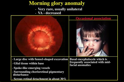 Ppt Congenital Optic Nerve Anomalies Powerpoint Presentation Free Download Id 391991