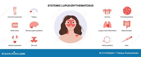 Systemic Lupus Erythematosus Cartoon Vector 313677707