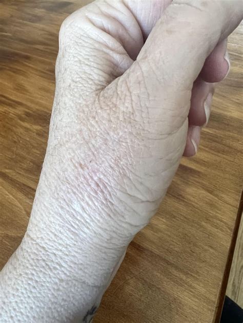 Cmc Joint Arthroplasty R Medizzy