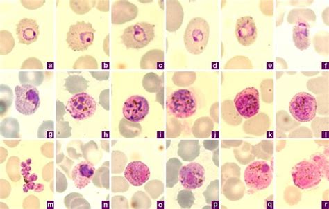 Plasmodium Ovale Laboratory Diagnosis