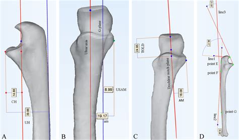 Measurement Of Coronoid Height Ch And Ulnar Height Uh A