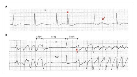 Qt Prolongation Of The Heart