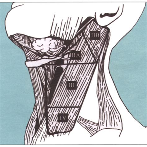 C Selective Neck Dissection Lymph Node Levels Ii Iv Download Scientific Diagram