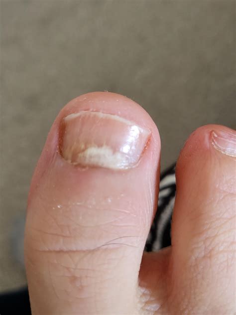 Please Help What Is This Does It Look Like Fungus Nail Infection