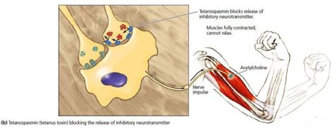 Tetanus Etiology Pathogenesis And Treatment Microbiology Notes