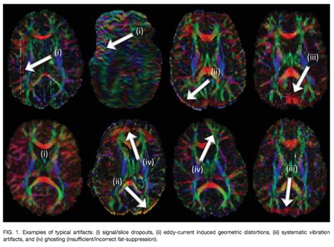Dti Quality Control Part 4 Further Reading Diffusion Imaging Introduction Tutorials And
