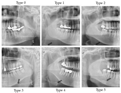 Hyoid Bone X Ray