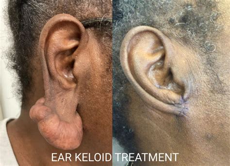 Ear Keloid Treatment Specialised Approaches For Complex Cases London