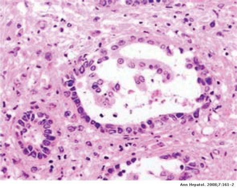 Cholangiocellular Hepatocarcinoma Annals Of Hepatology